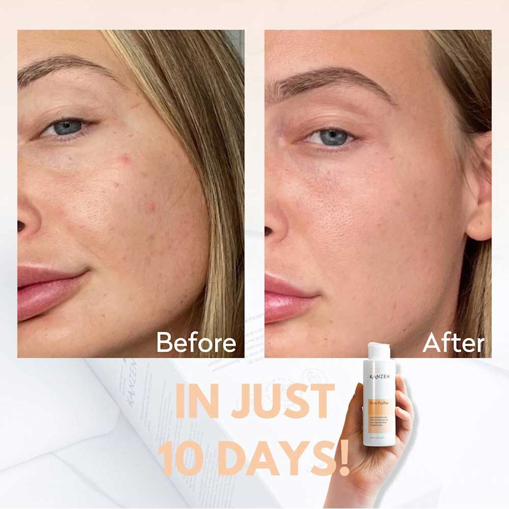 Kanzen Pore Purifier 30ml | GLAMBEAUTY